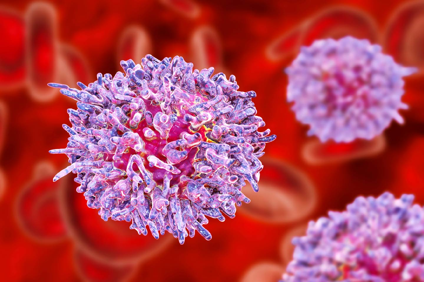 Leucemia linfatica, rimborsata cura a durata fissa senza chemio ...