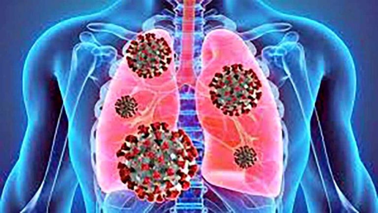 Le fibrosi polmonari al centro: un impegno condiviso per i pazienti ...